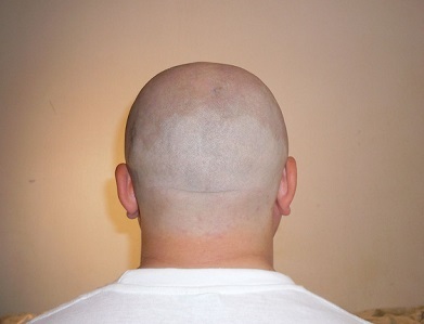 Hair Follicle Discovery Could Speed Wound Healing